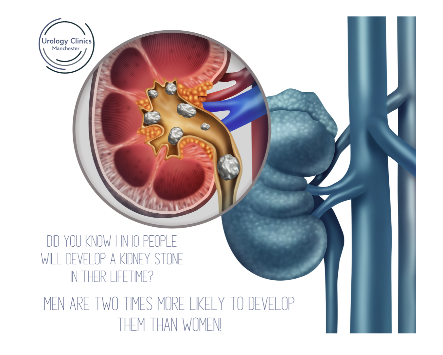 Kidney Stones - Urology Clinics - Urologist Manchester
